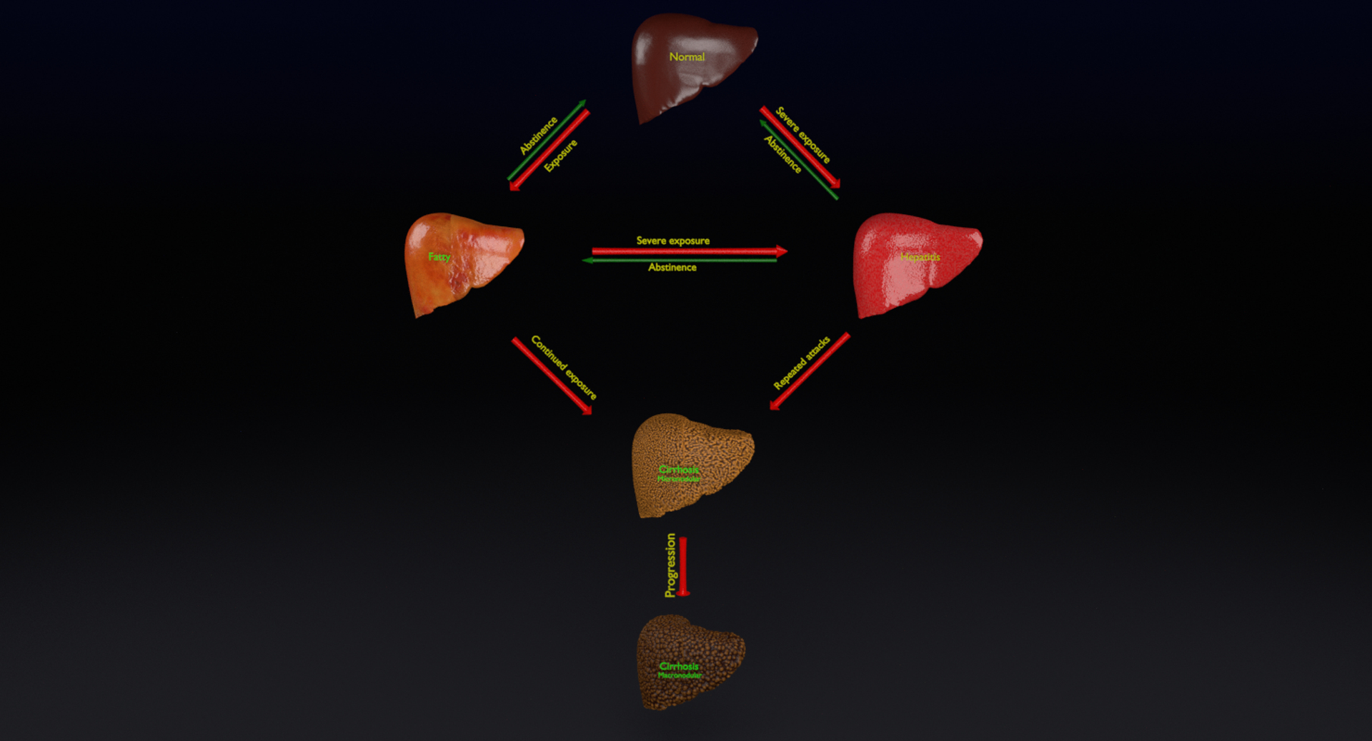 3D alcoholic liver disease fatty model - TurboSquid 1382254