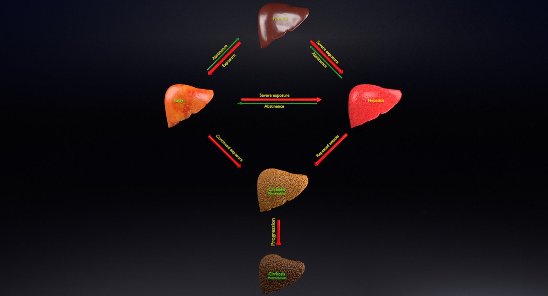 3D Alcoholic Liver Disease Fatty Model - TurboSquid 1382254