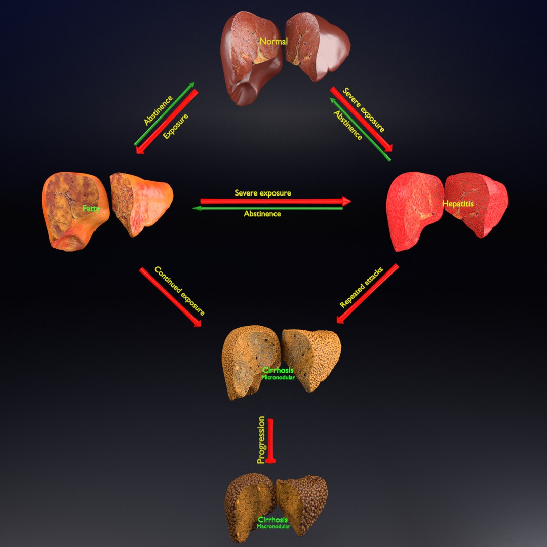 3D Alcoholic Liver Disease Fatty Model - TurboSquid 1382254