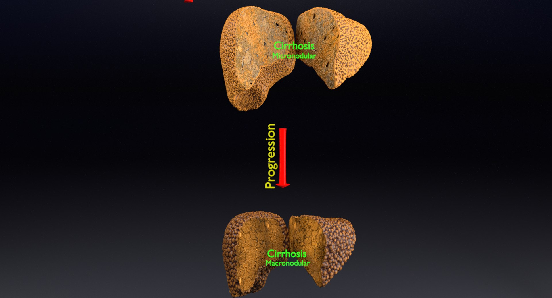 3D Alcoholic Liver Disease Fatty Model - TurboSquid 1382254
